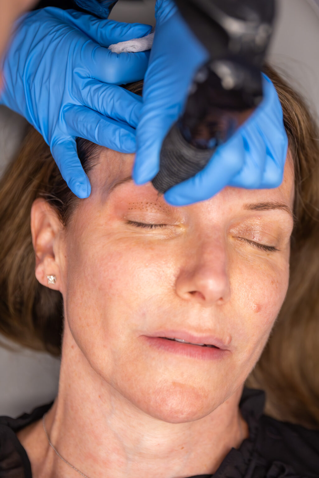 Plasma Pen in Wheeling | ThrIVe Wheeling