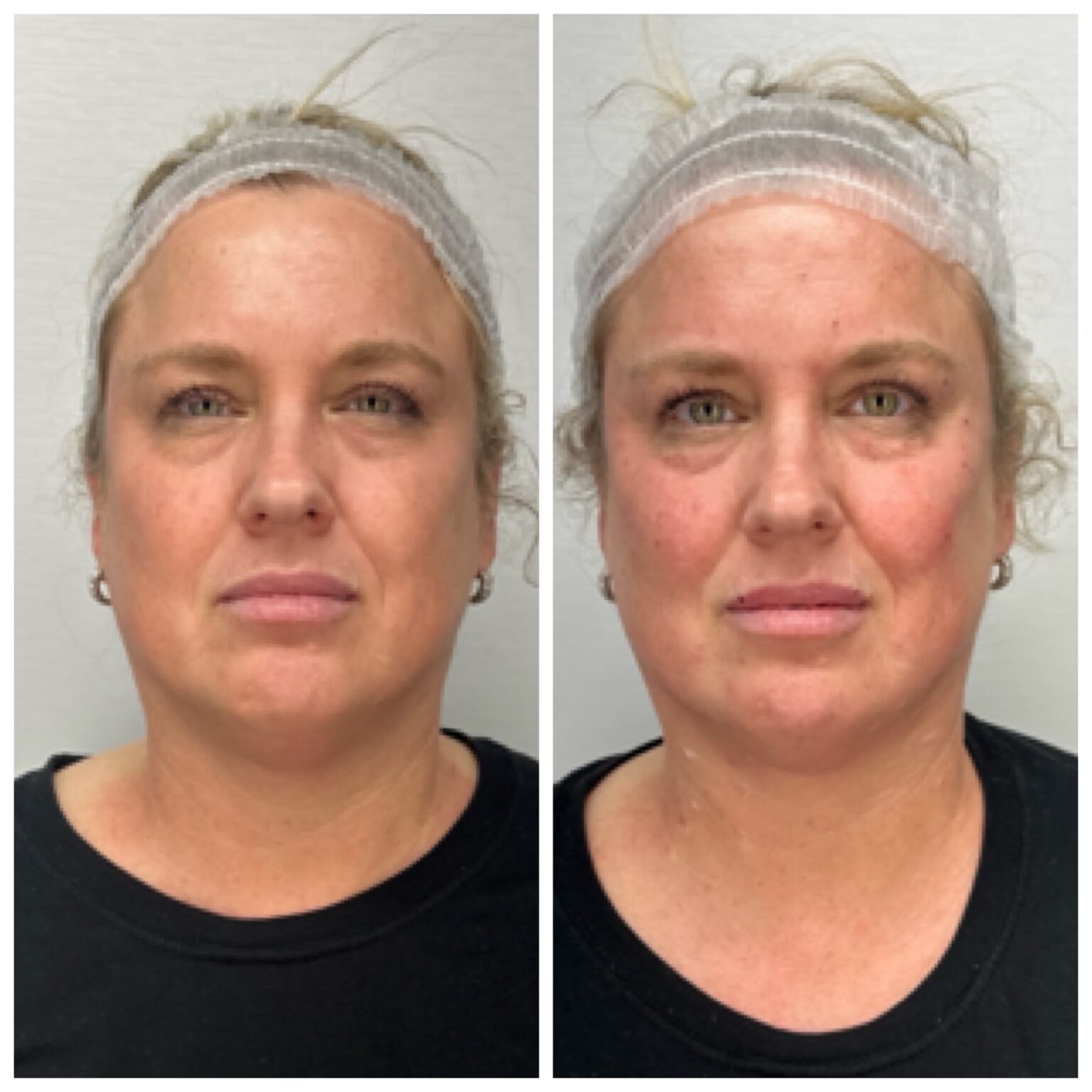 Full Face Filler + Emface 1 | ThrIVe Wheeling