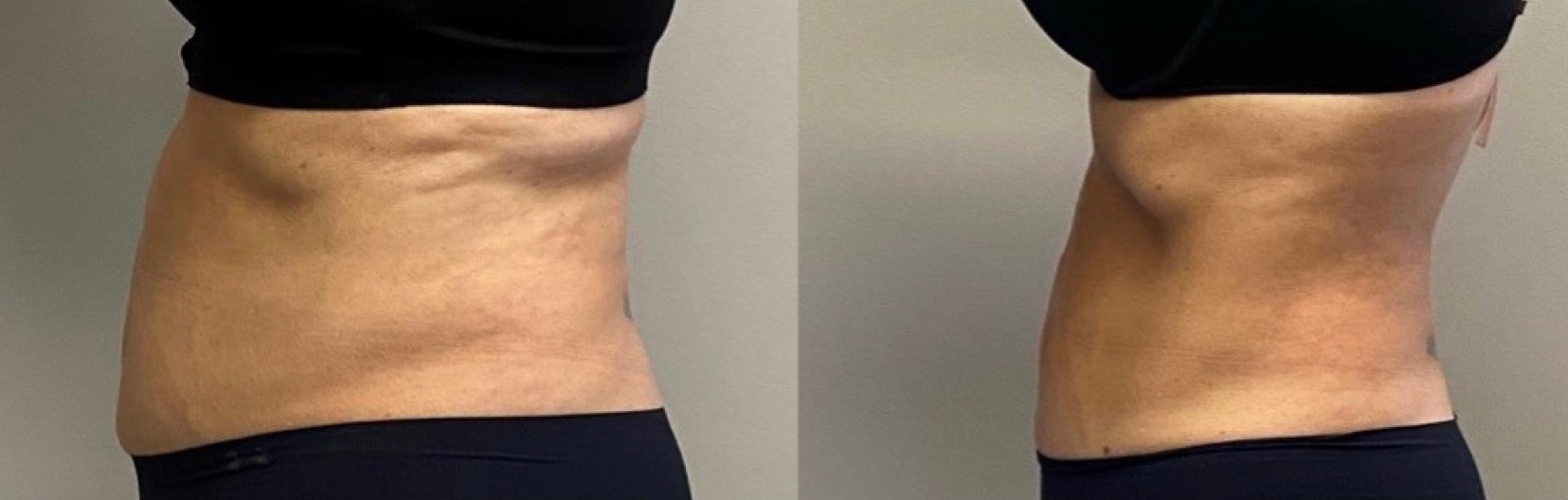 Weight Loss + Emsculpt NEO 1 | ThrIVe Wheeling